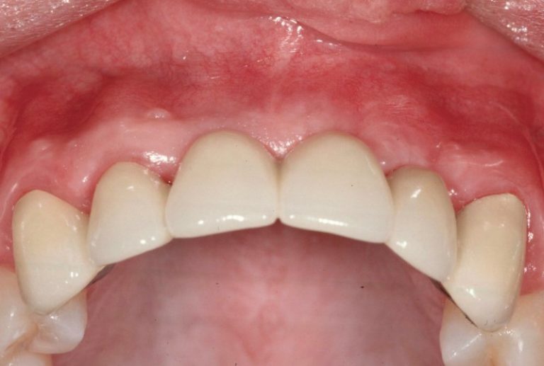 Periodontal Therapy - Portland Perio Implant Center