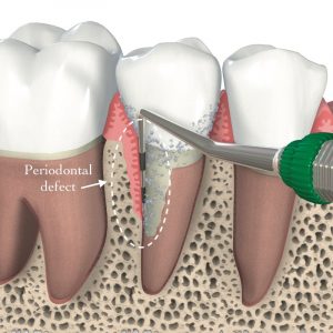 Periodontal Regeneration - Portland Perio Implant Center