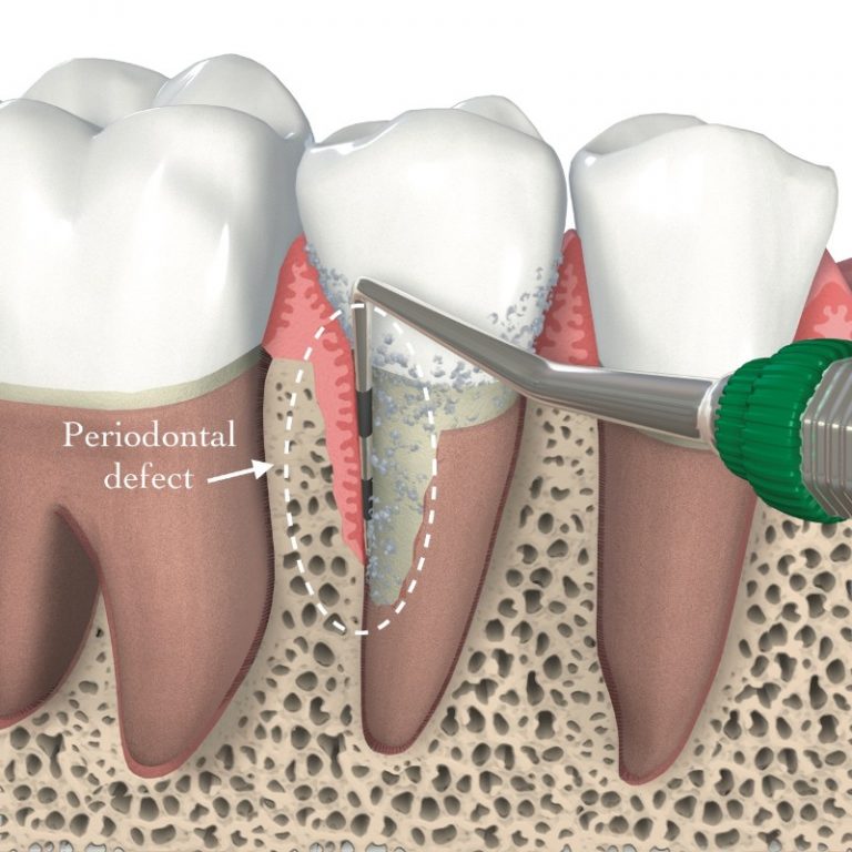 Periodontal Regeneration - Portland Perio Implant Center