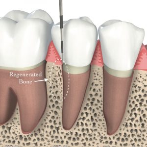 Periodontal Regeneration - Portland Perio Implant Center