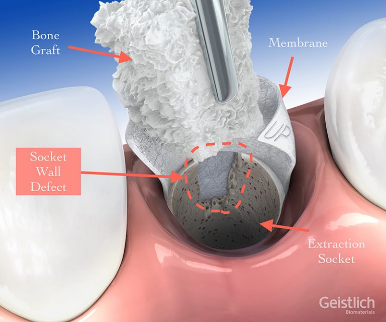 Bone Grafting - Portland Perio Implant Center