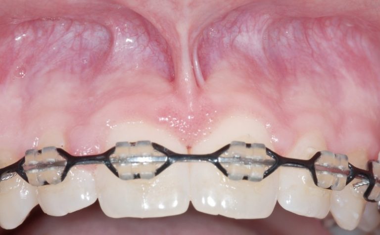 Periodontal Therapy - Portland Perio Implant Center