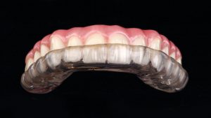 Occlusal Guards - Portland Perio Implant Center