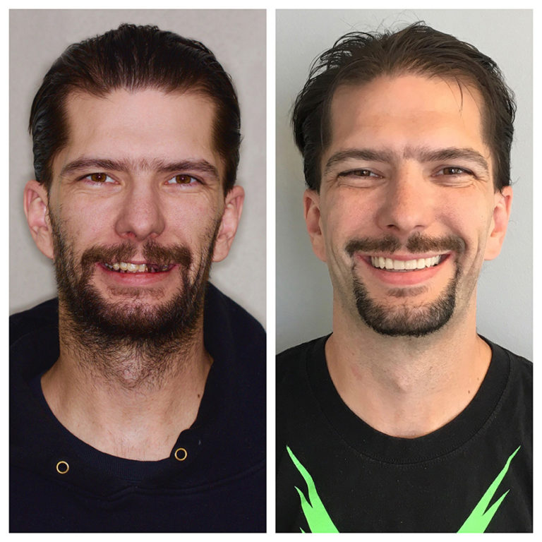 All-On-4 Dental Implants Case Study - Joshua - Portland Perio Implant ...