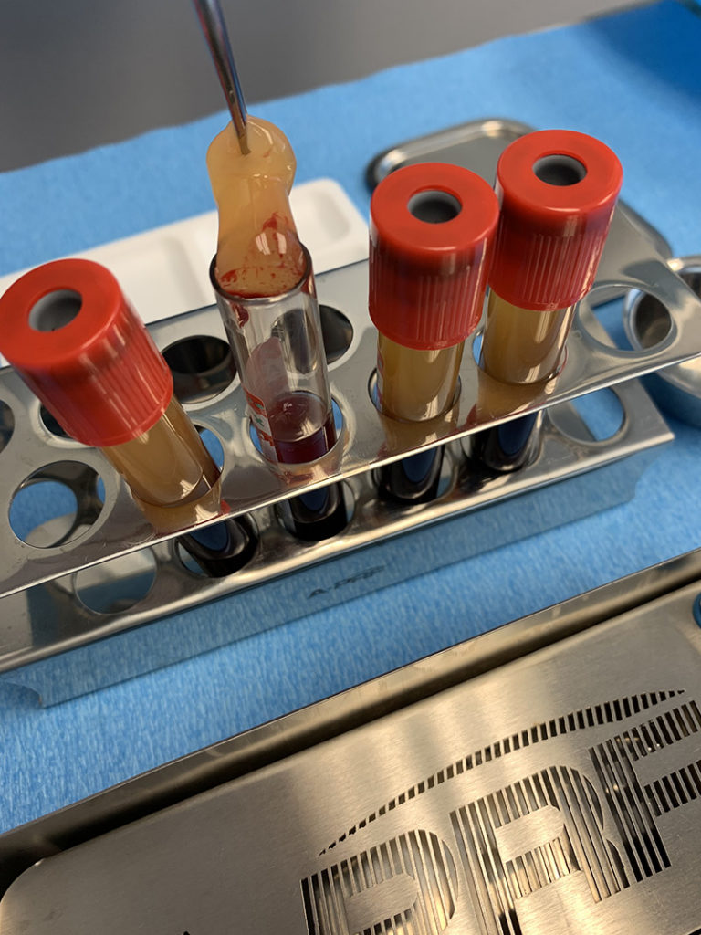 Platelet Rich Fibrin (PRF Regeneration) - Portland Perio Implant Center