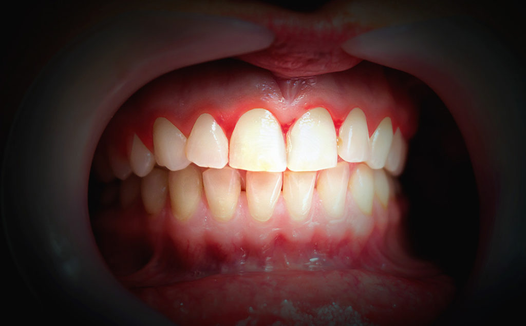 Why Bleeding Gums Are A Big Deal - Portland Perio Implant Center