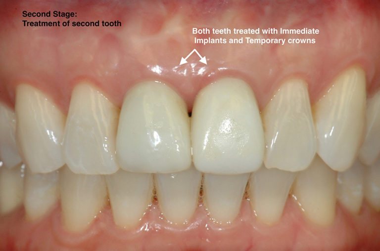 Dental Implants In The Esthetic Zone - Yili - Portland Perio Implant Center