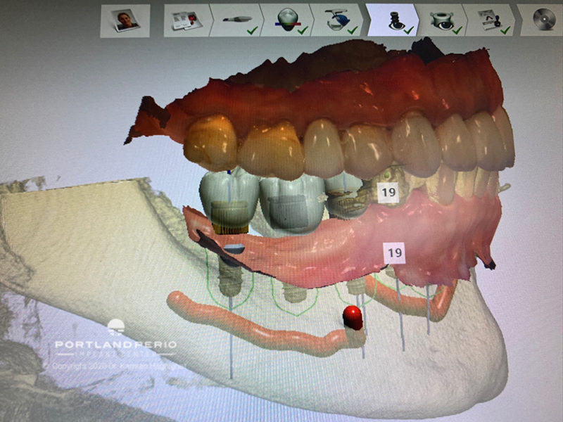 How Digital Technology is Changing the Dental Implant Process