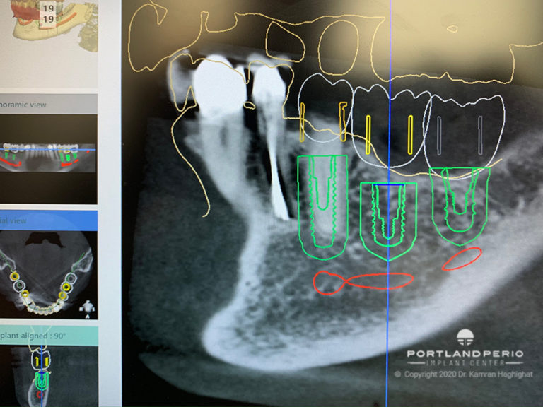 How Digital Technology is Changing the Dental Implant Process